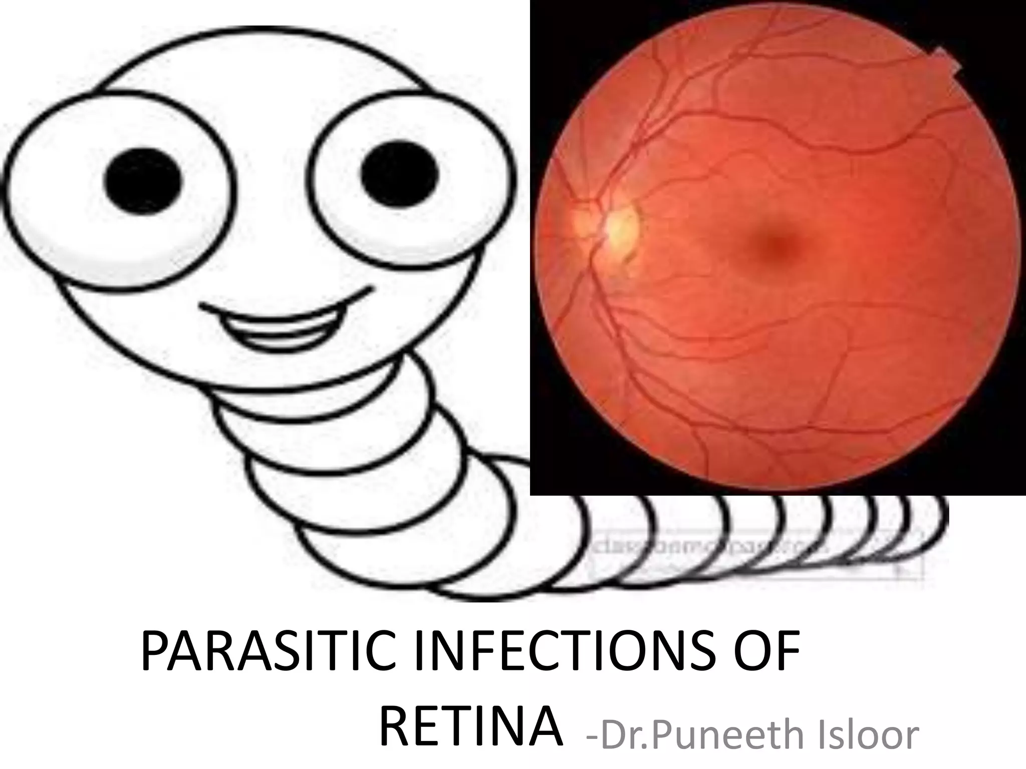 Parasitic infections of retina | PPTX