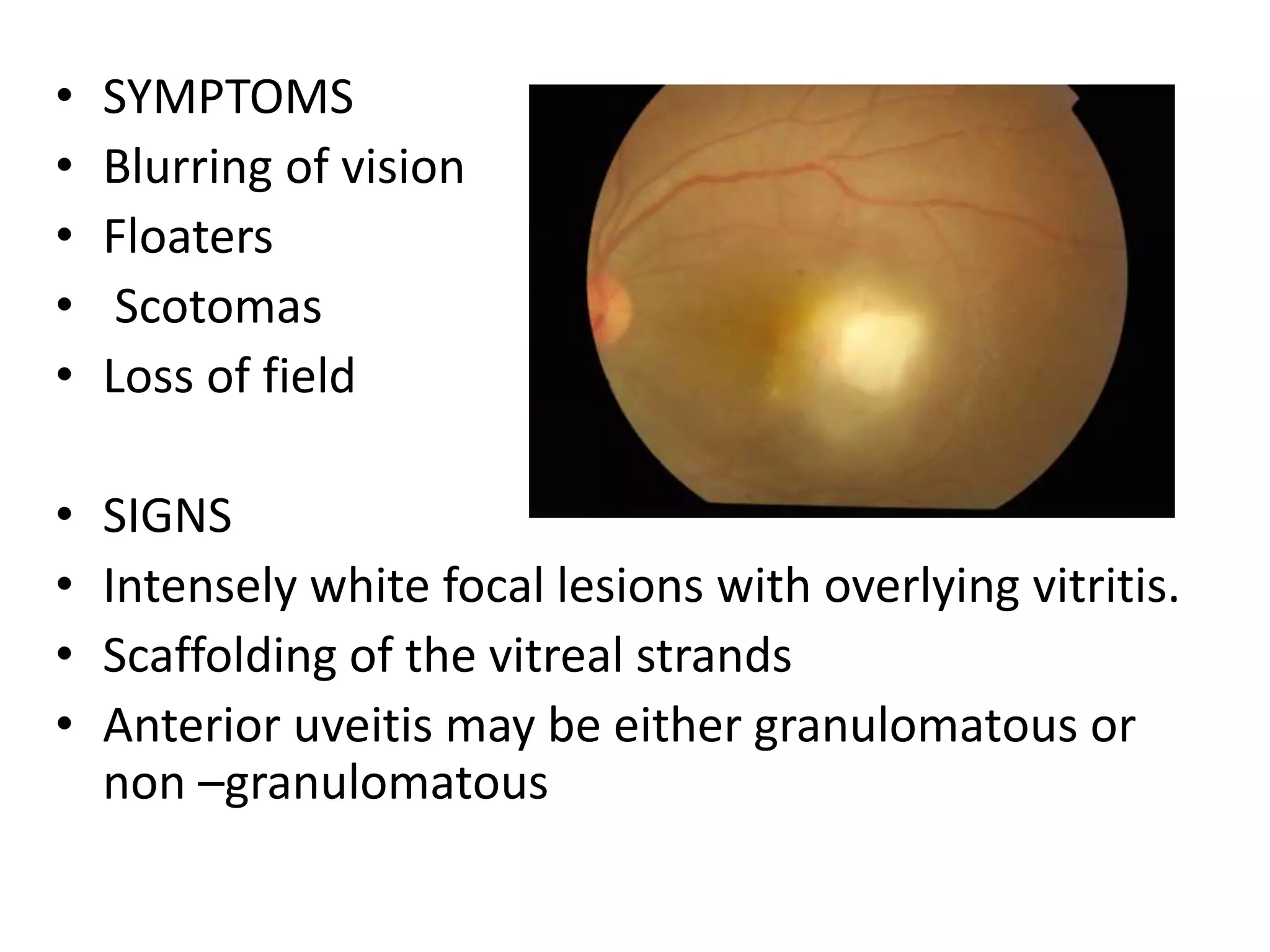 Parasitic infections of retina | PPTX