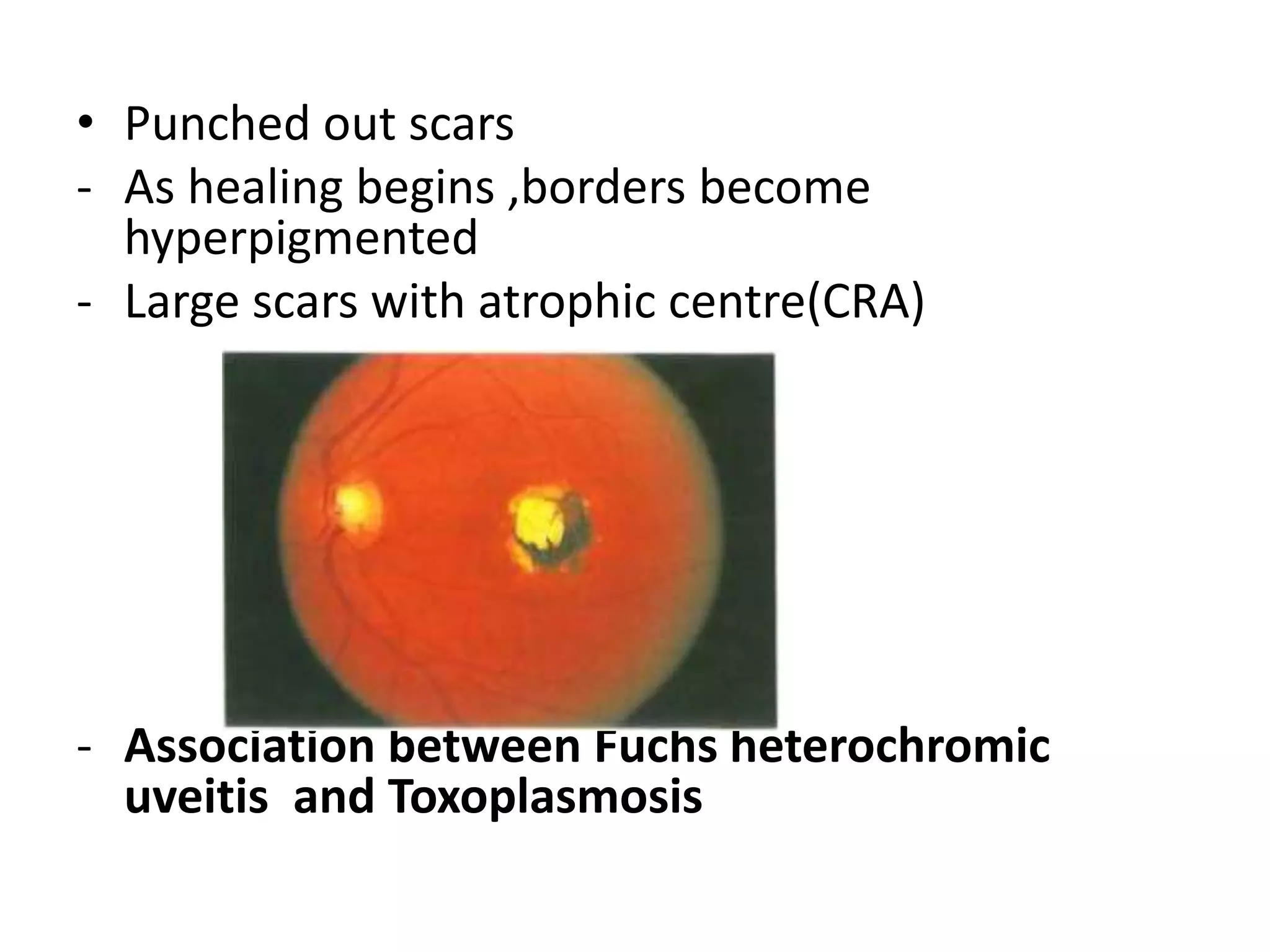 Parasitic infections of retina | PPTX