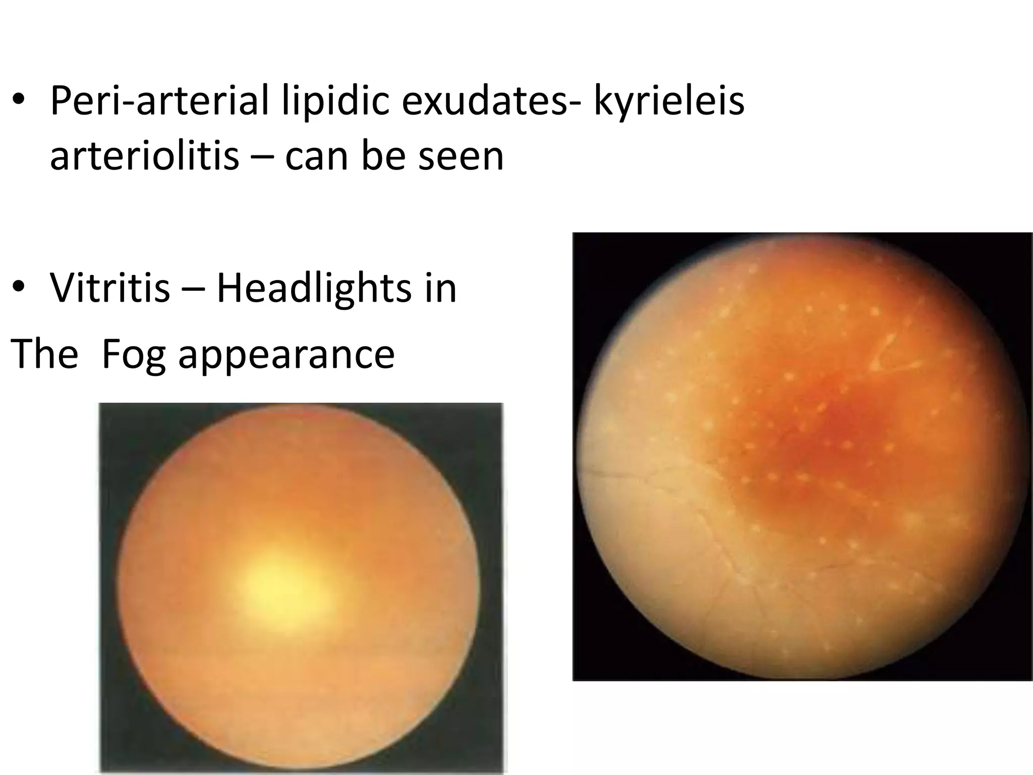 Parasitic infections of retina | PPTX