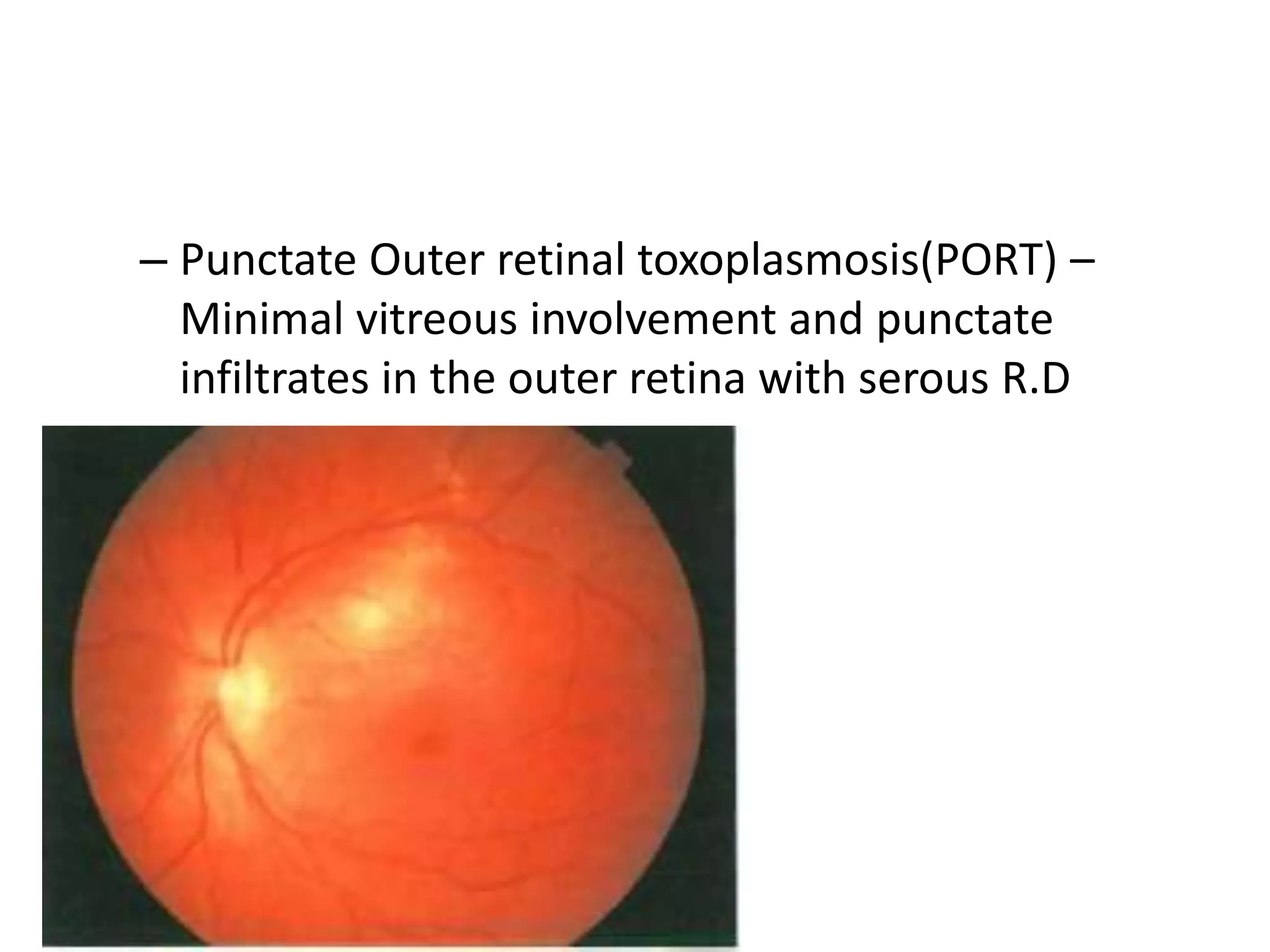 Parasitic infections of retina | PPTX