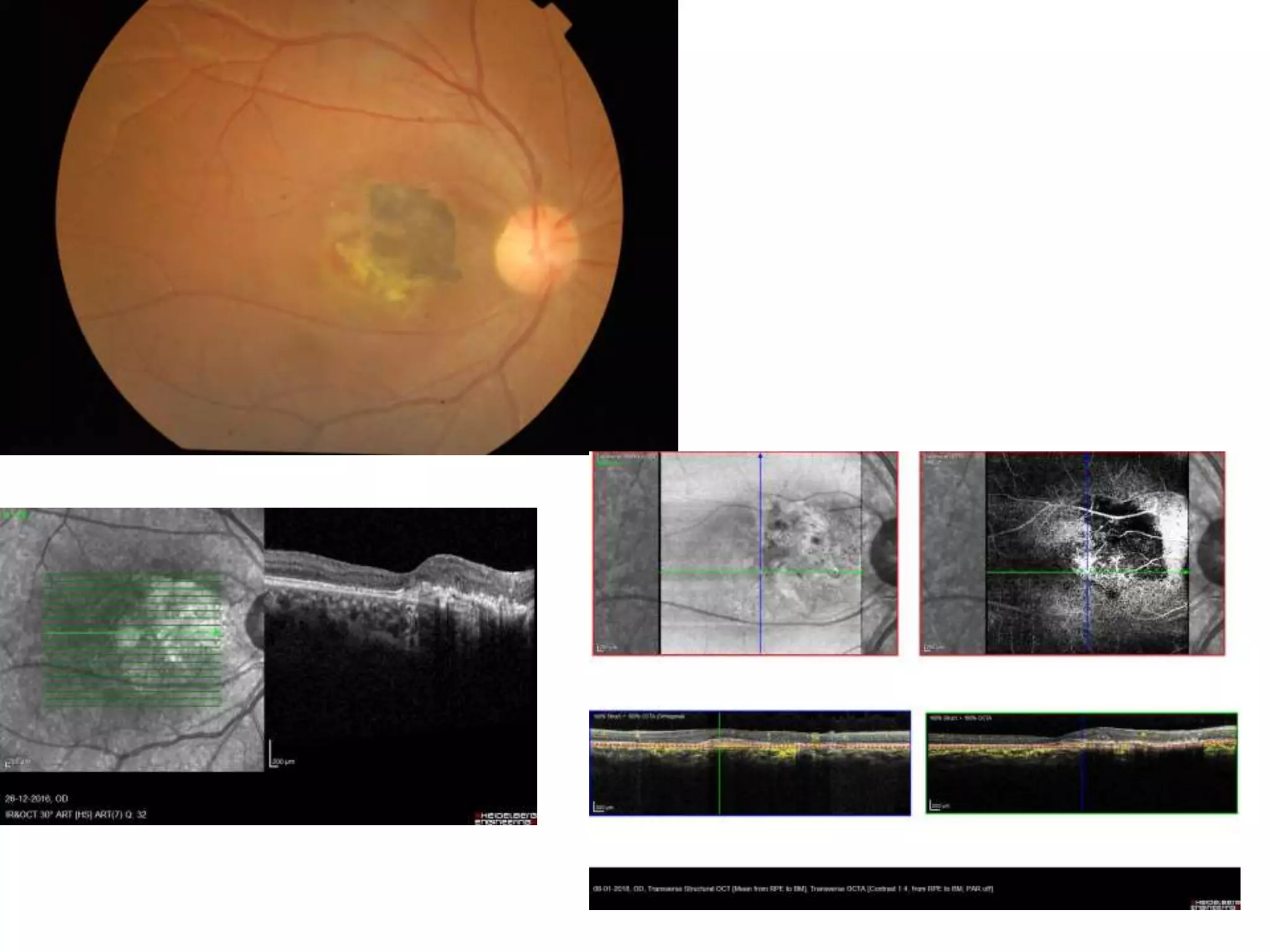 Parasitic infections of retina | PPTX