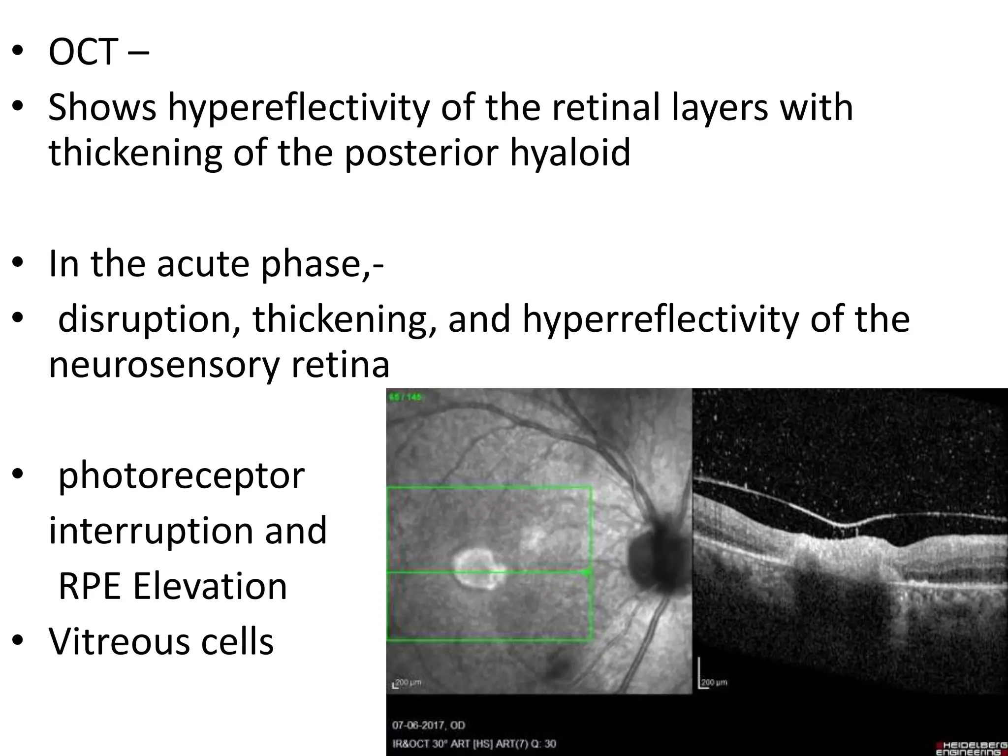 Parasitic infections of retina | PPTX