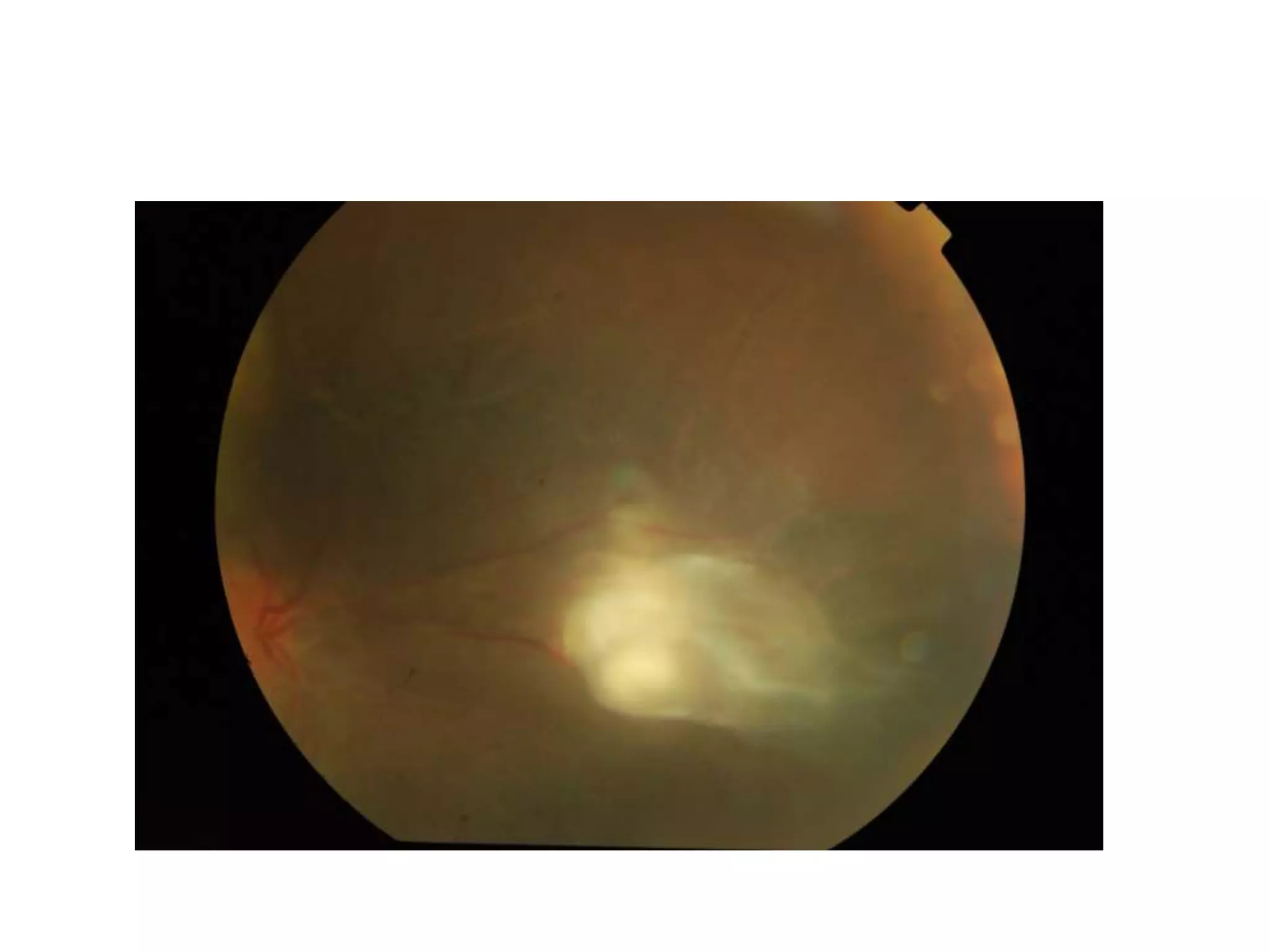 Parasitic infections of retina | PPTX