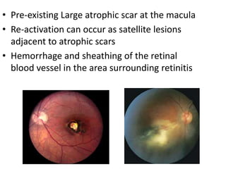 Parasitic infections of retina | PPTX
