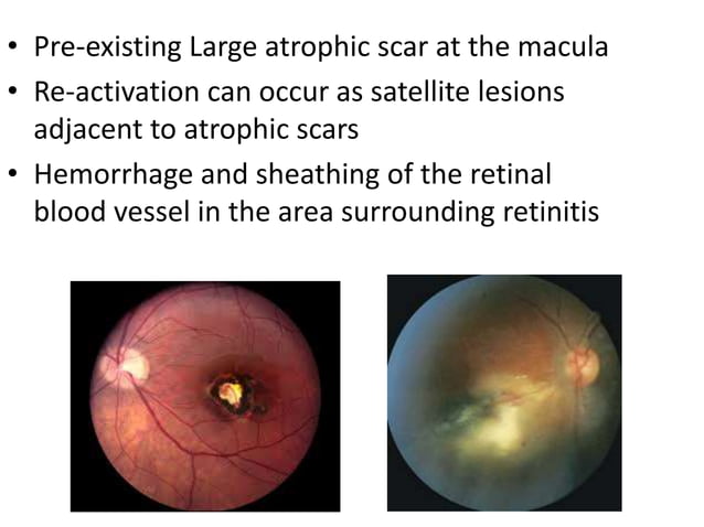 Parasitic infections of retina | PPTX | Eye and Vision Conditions ...