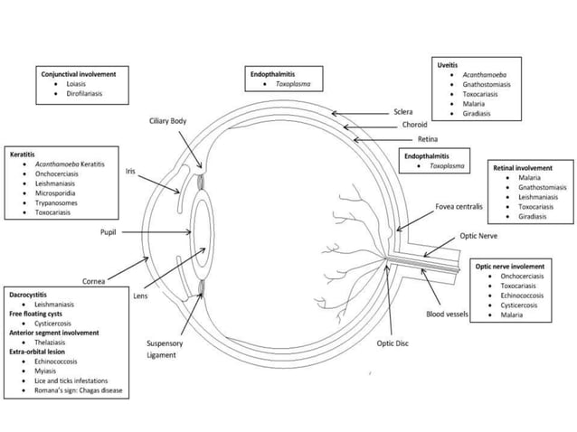 Parasitic infections of retina | PPTX | Eye and Vision Conditions ...