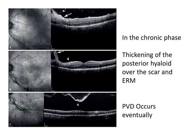 Parasitic infections of retina | PPTX | Eye and Vision Conditions ...