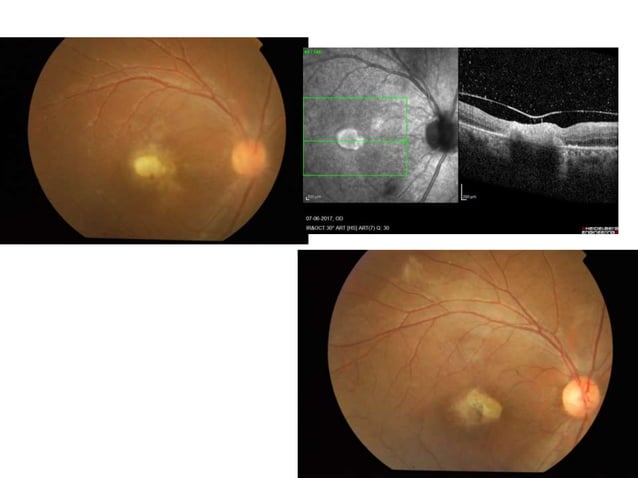 Parasitic infections of retina | PPTX | Eye and Vision Conditions ...