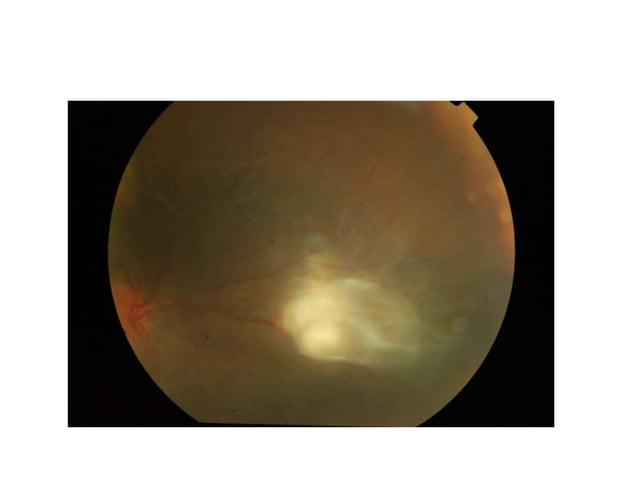 Parasitic infections of retina | PPTX | Eye and Vision Conditions ...