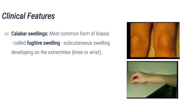 Parasitic Infections of Skin, Soft tissue and musculoskeletal system dr ...