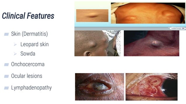 Parasitic Infections of Skin, Soft tissue and musculoskeletal system dr ...