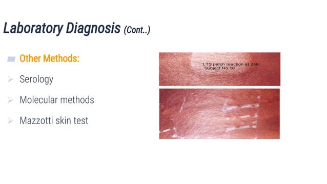 Parasitic Infections of Skin, Soft tissue and musculoskeletal system dr ...