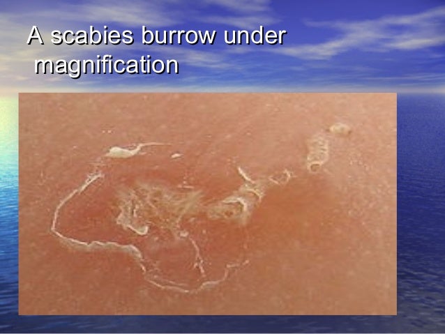 Parasitic skin infestation