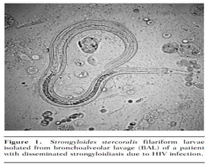 Strongyloides stercoralis hyperinfection in a patient with aids | PPT