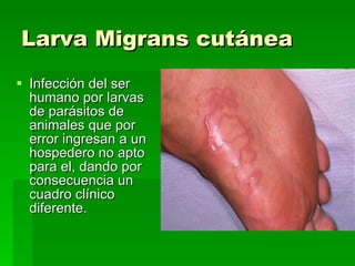 Parasitosis De Piel, Larva Migrante Cutanea Y Artropodos | PPT