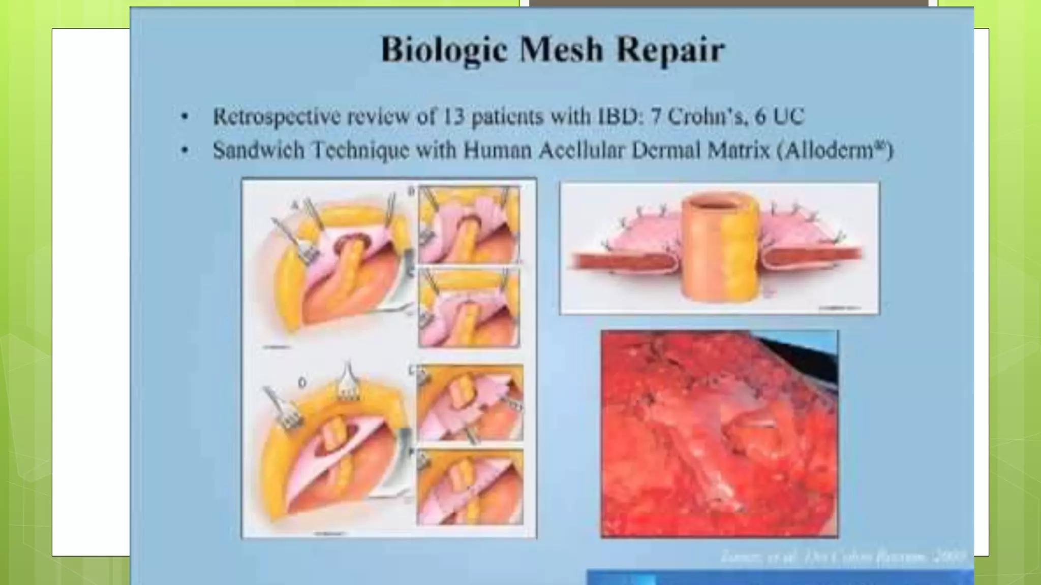 Parastomal hernia | PPTX | Digestive Disorders | Diseases and Conditions