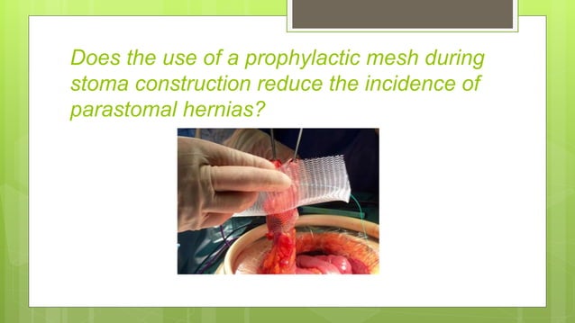 Parastomal hernia | PPTX | Digestive Disorders | Diseases and Conditions