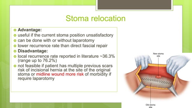 Parastomal hernia | PPTX | Digestive Disorders | Diseases and Conditions