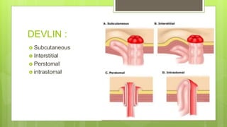 Parastomal hernia | PPT