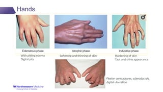 Skin Signs of Scleroderma: A Dermatological Approach to Diagnosis and ...