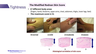 Skin Signs of Scleroderma: A Dermatological Approach to Diagnosis and ...