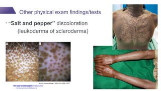 Skin Signs of Scleroderma: A Dermatological Approach to Diagnosis and ...