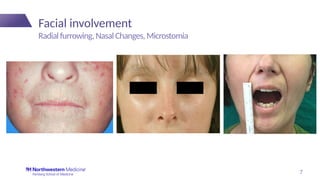 Skin Signs of Scleroderma: A Dermatological Approach to Diagnosis and ...