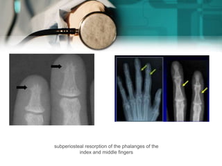 Disorders of parathyroid gland | PPT