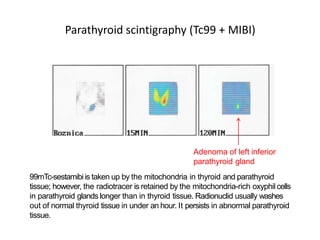 Parathyroid disorders - Etiopathogenesis, Clinical features, Advances ...