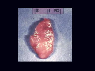 PARATHYROID GLANDS and diseases ppt .ppt