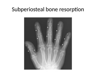 PARATHYROID BENIGN AND MALIGNANT LESIONS | PPT