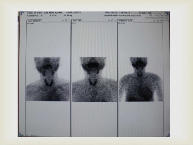 Parathyroid Scan