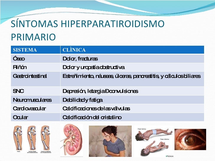 Sintomas De Hiperparatireoidismo