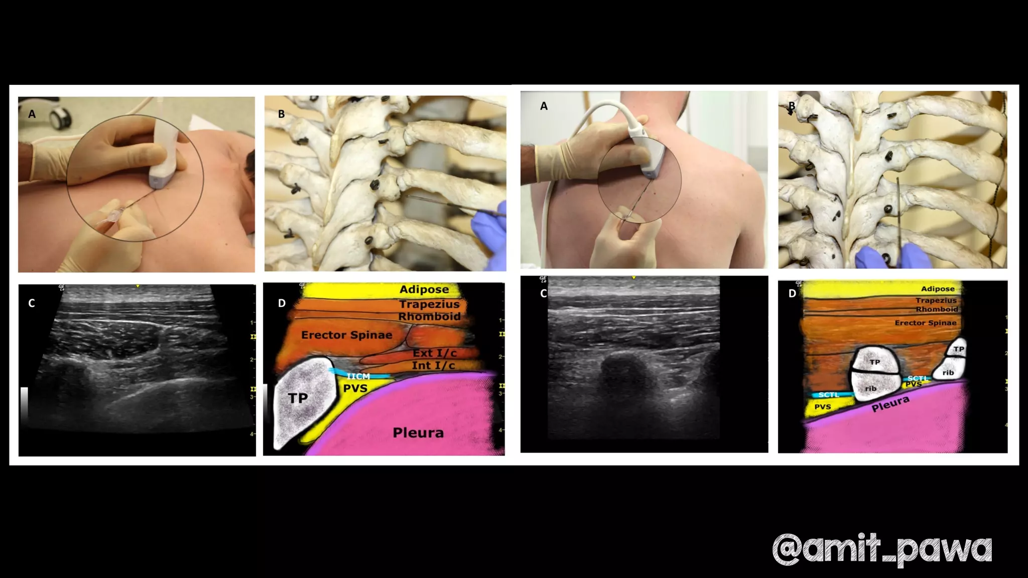 Paravertebral block | PDF