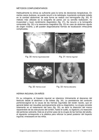 Cirugía de la pared abdominal: Hernia, eventración y evisceración | PDF
