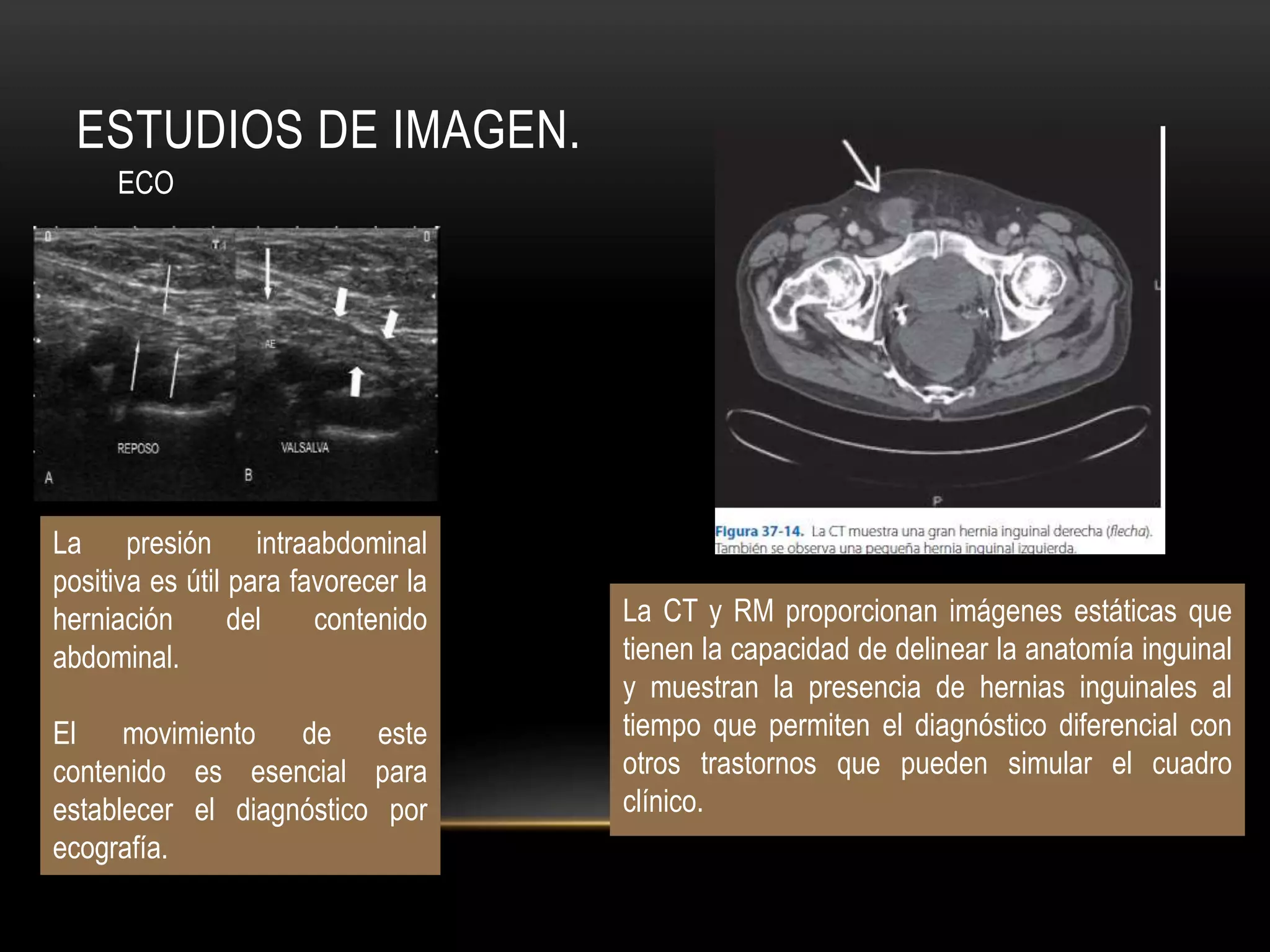 Pared abdominal: Hernias de la Región Inguino-crural | PPT