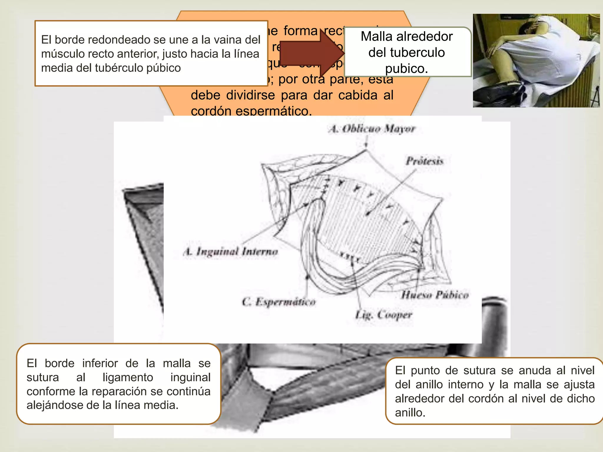 Pared abdominal: Hernias de la Región Inguino-crural | PPT