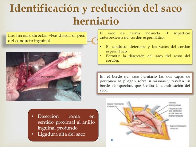 Pared abdominal: Hernias de la Región Inguino-crural