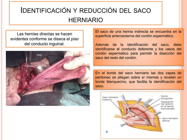 Pared abdominal: Hernias region inguino-crural | PPTX