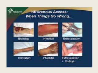 Phlebitis Vs Infiltration