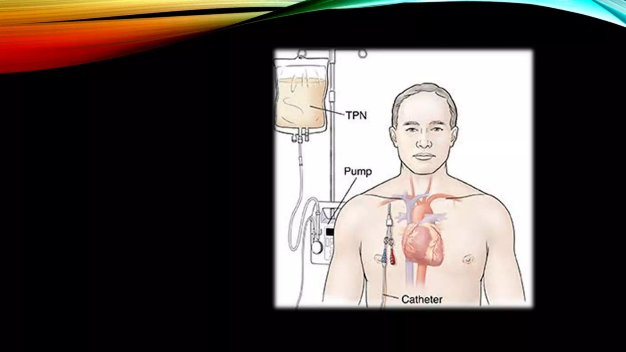 Parenteral Nutrition | PPT