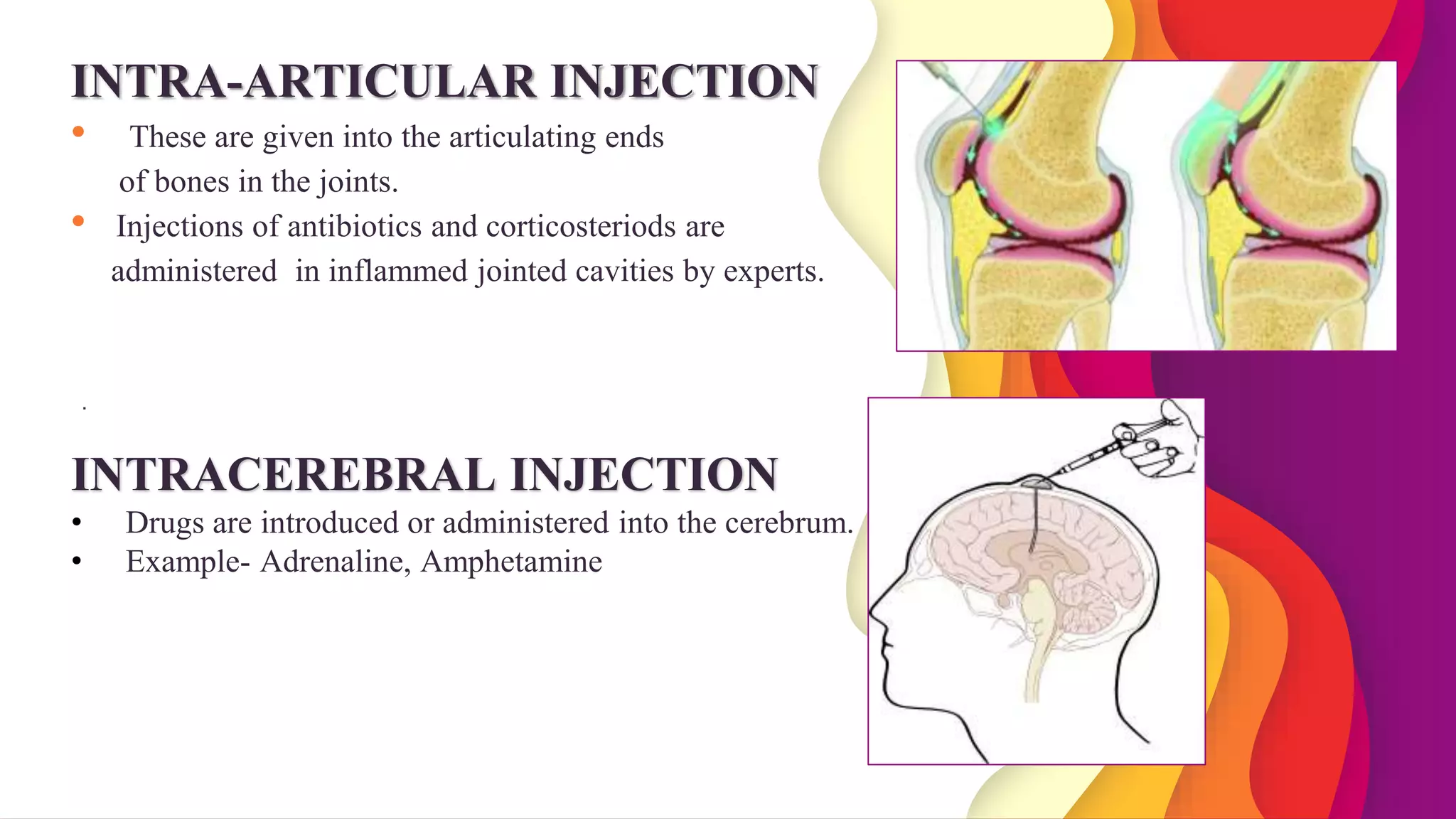 Types of Parenteral Formulation | PPTX
