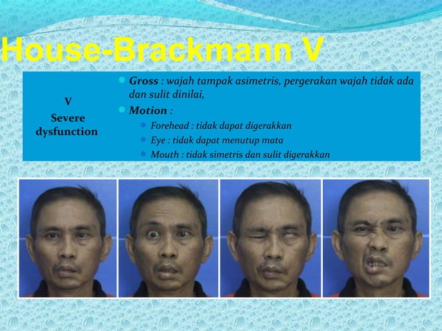 Parese nervus fasialis | PPT