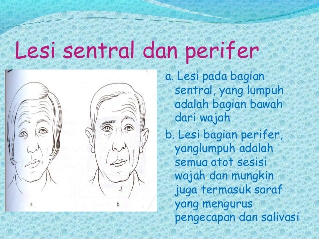 Parese nervus fasialis