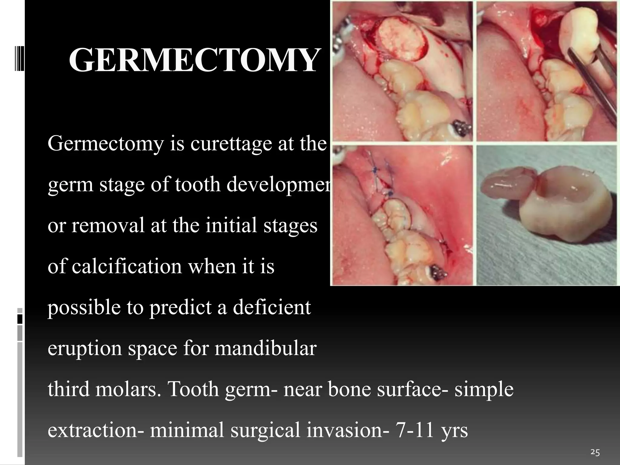 SURGICAL EXTRACTION OF MANDIBULAR THIRD MOLAR | PPTX