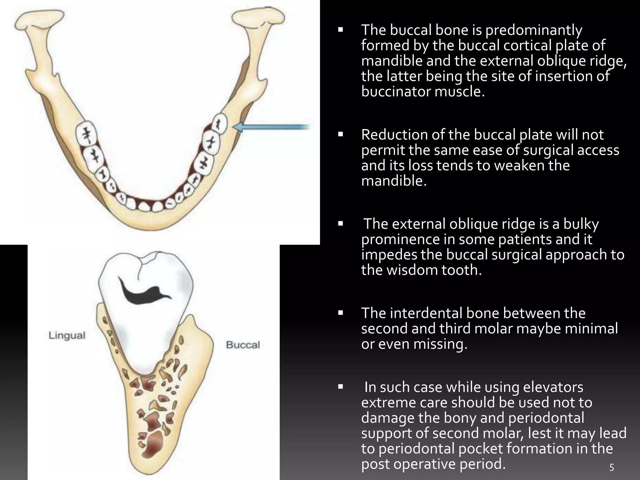 SURGICAL EXTRACTION OF MANDIBULAR THIRD MOLAR | PPTX
