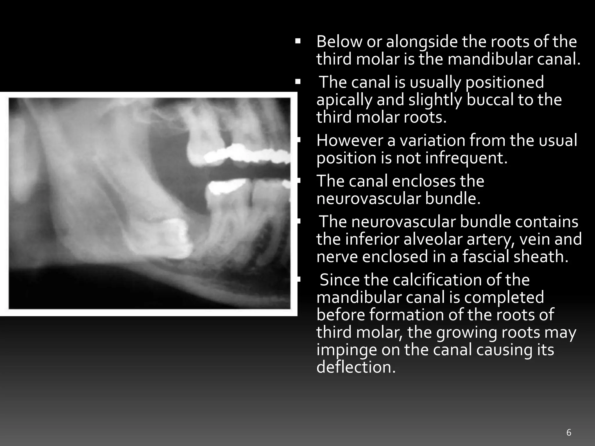 SURGICAL EXTRACTION OF MANDIBULAR THIRD MOLAR | PPTX
