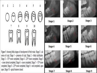 SURGICAL EXTRACTION OF MANDIBULAR THIRD MOLAR | PPTX