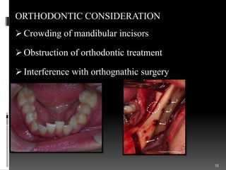 SURGICAL EXTRACTION OF MANDIBULAR THIRD MOLAR | PPTX